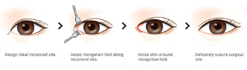 Canthoplasty Eye Treatment in Ludhiana, Punjab, India