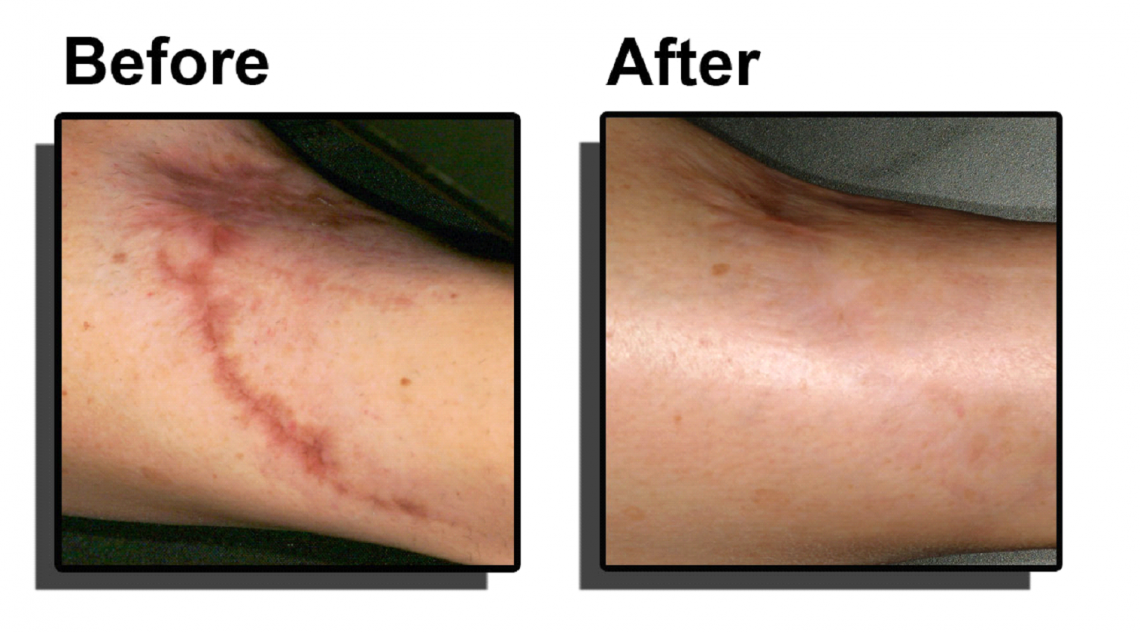 Scar Removal Surgery, Revision and Cost in Ludhiana, Punjab, India